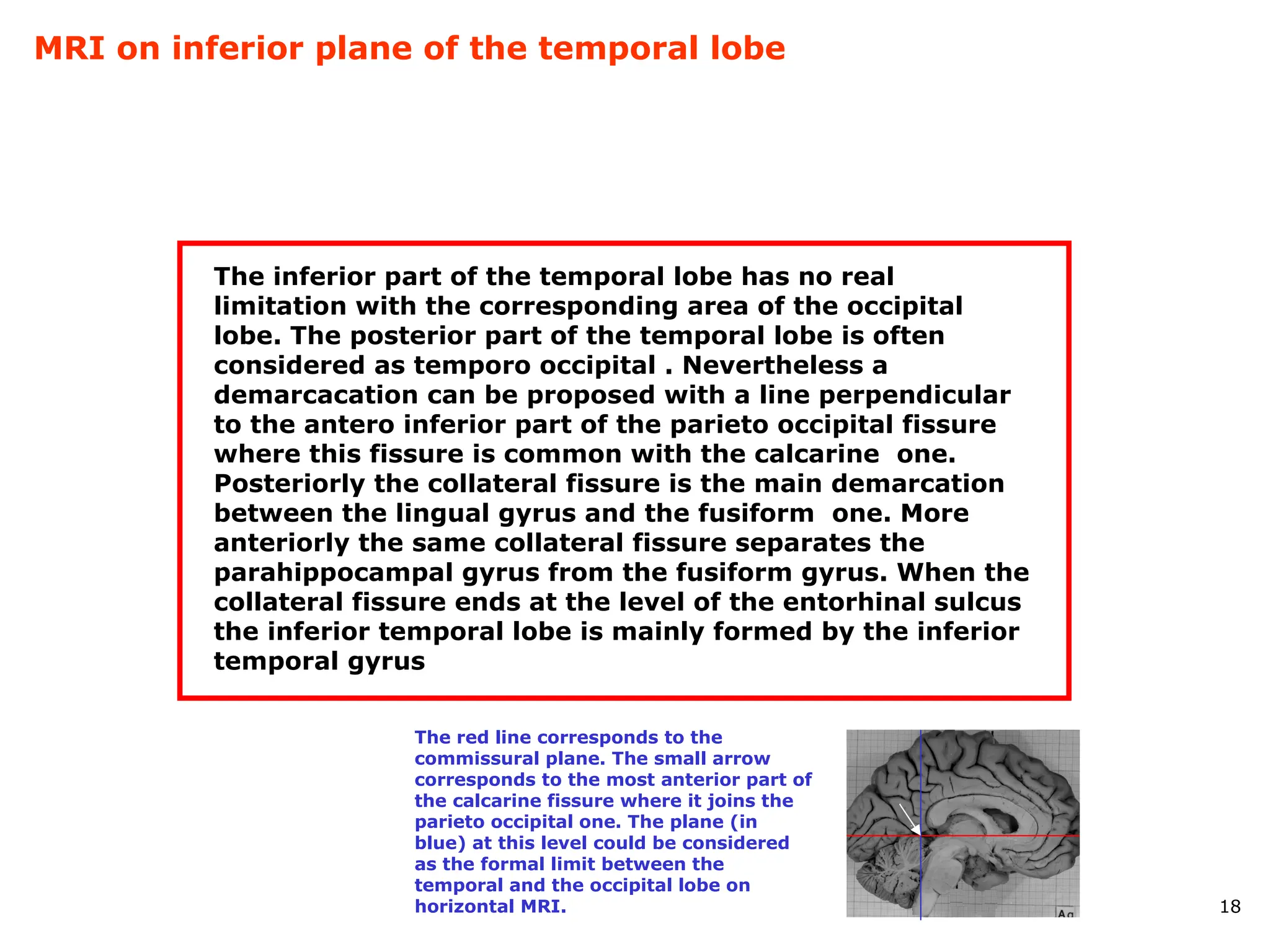 MRI of Normal Brain 3D with labels and lecture | PPT