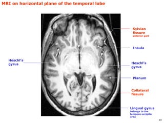 MRI of Normal Brain 3D with labels and lecture | PPT