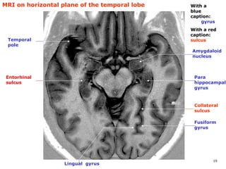 MRI of Normal Brain 3D with labels and lecture | PPT