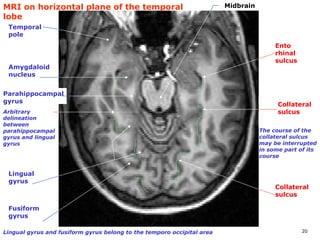 MRI of Normal Brain 3D with labels and lecture | PPT