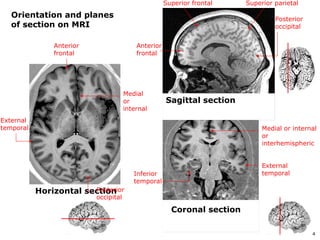 MRI of Normal Brain 3D with labels and lecture | PPT