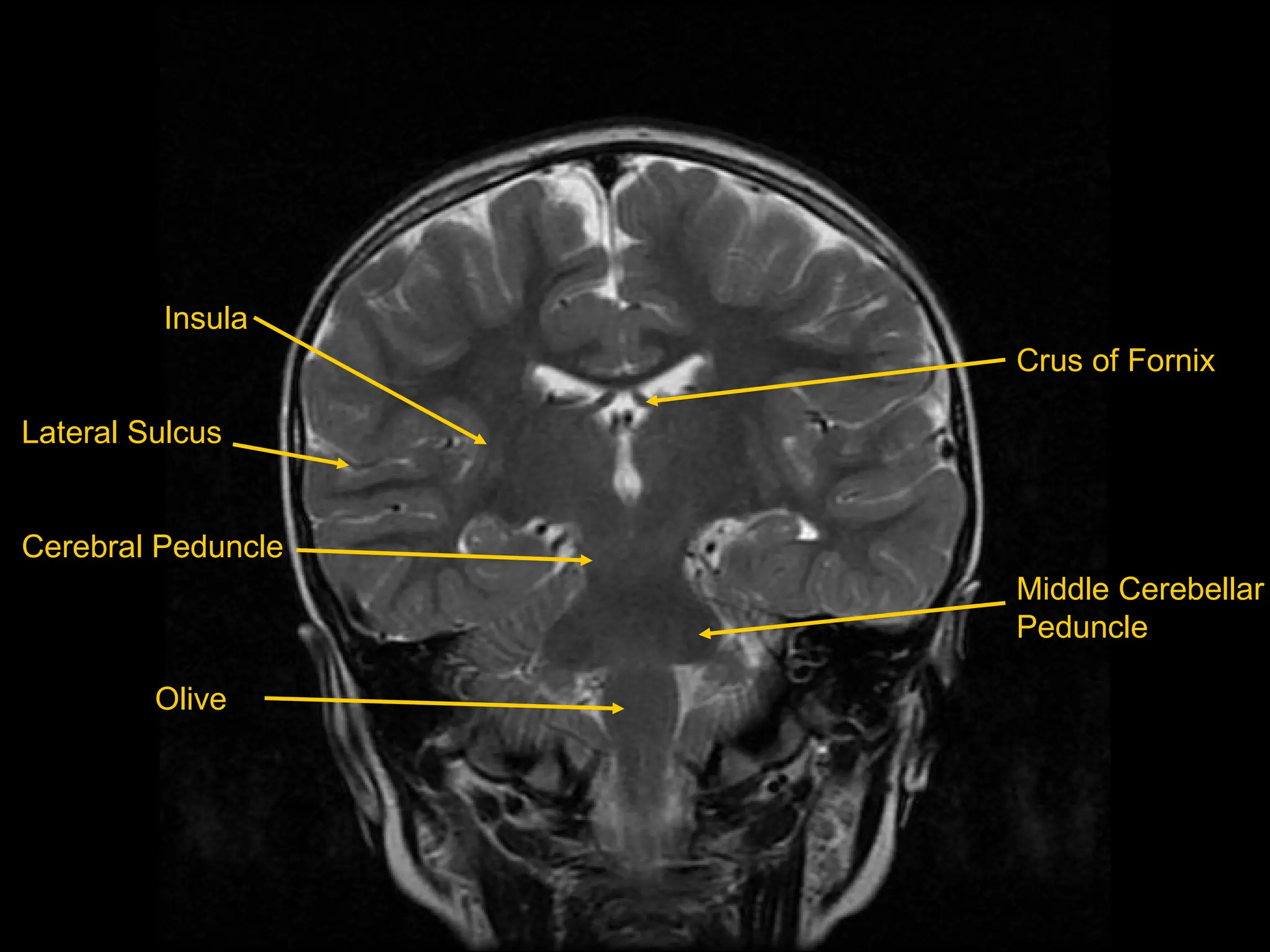 MRI of Normal Brain/Head and Neck with Labels | PPT