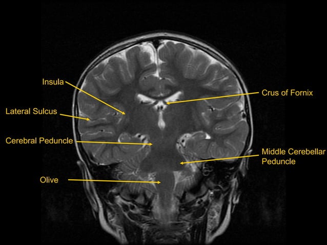 MRI of Normal Brain/Head and Neck with Labels | PPT