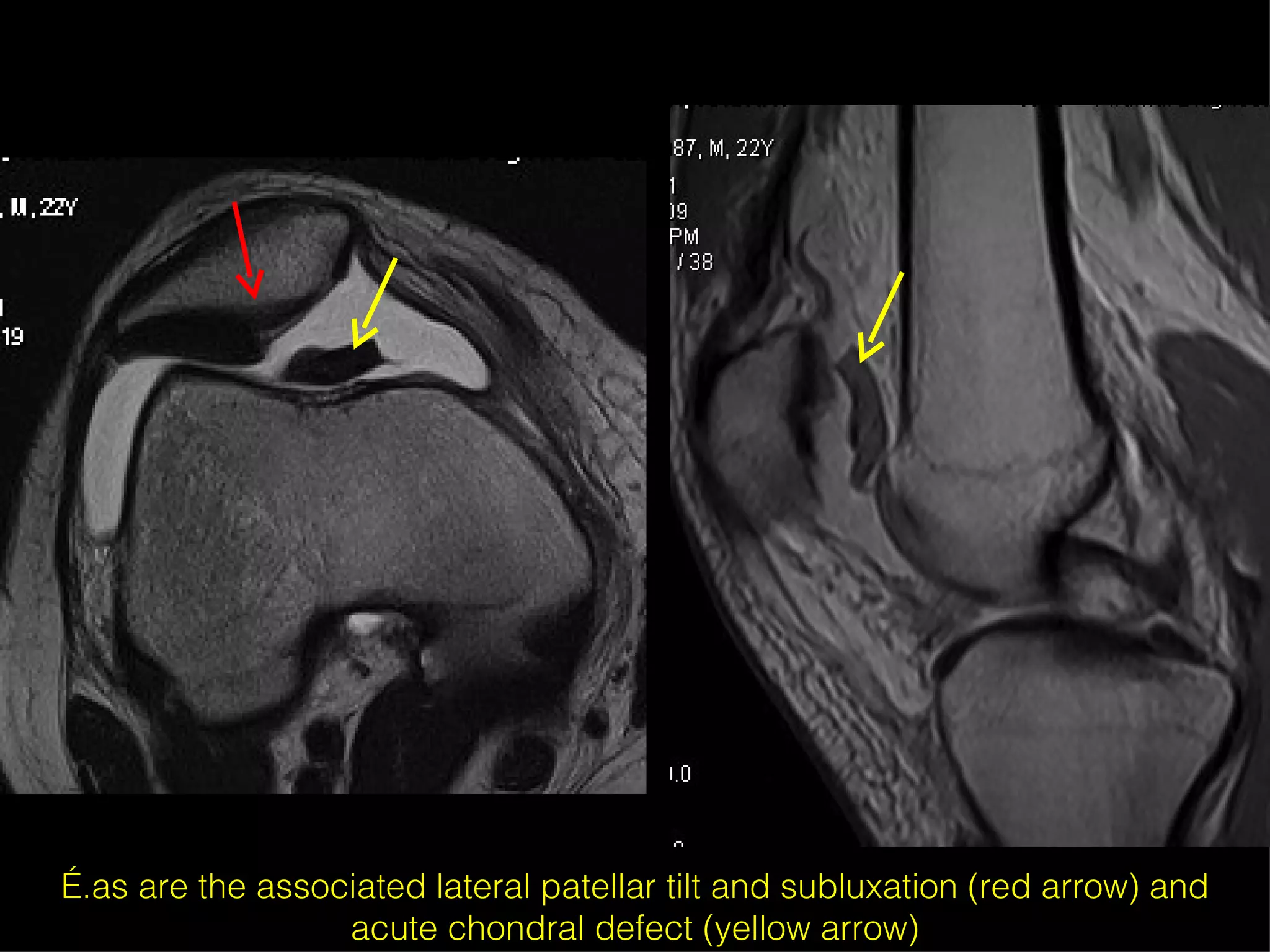 MRI of patellar disorders | PPT