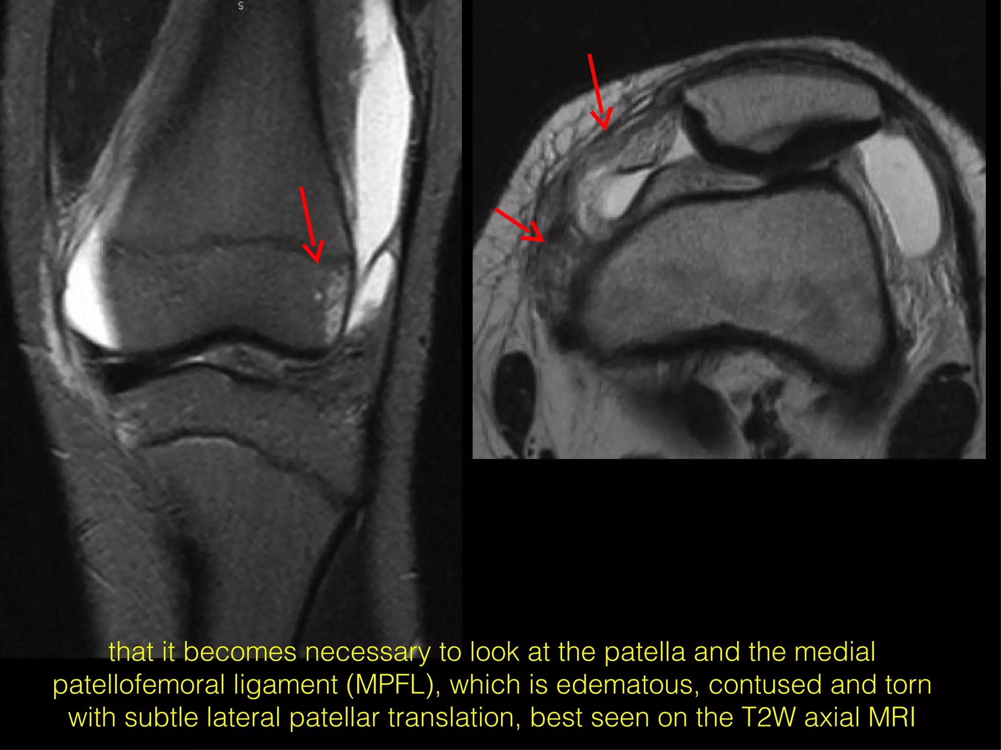 MRI of patellar disorders | PPT