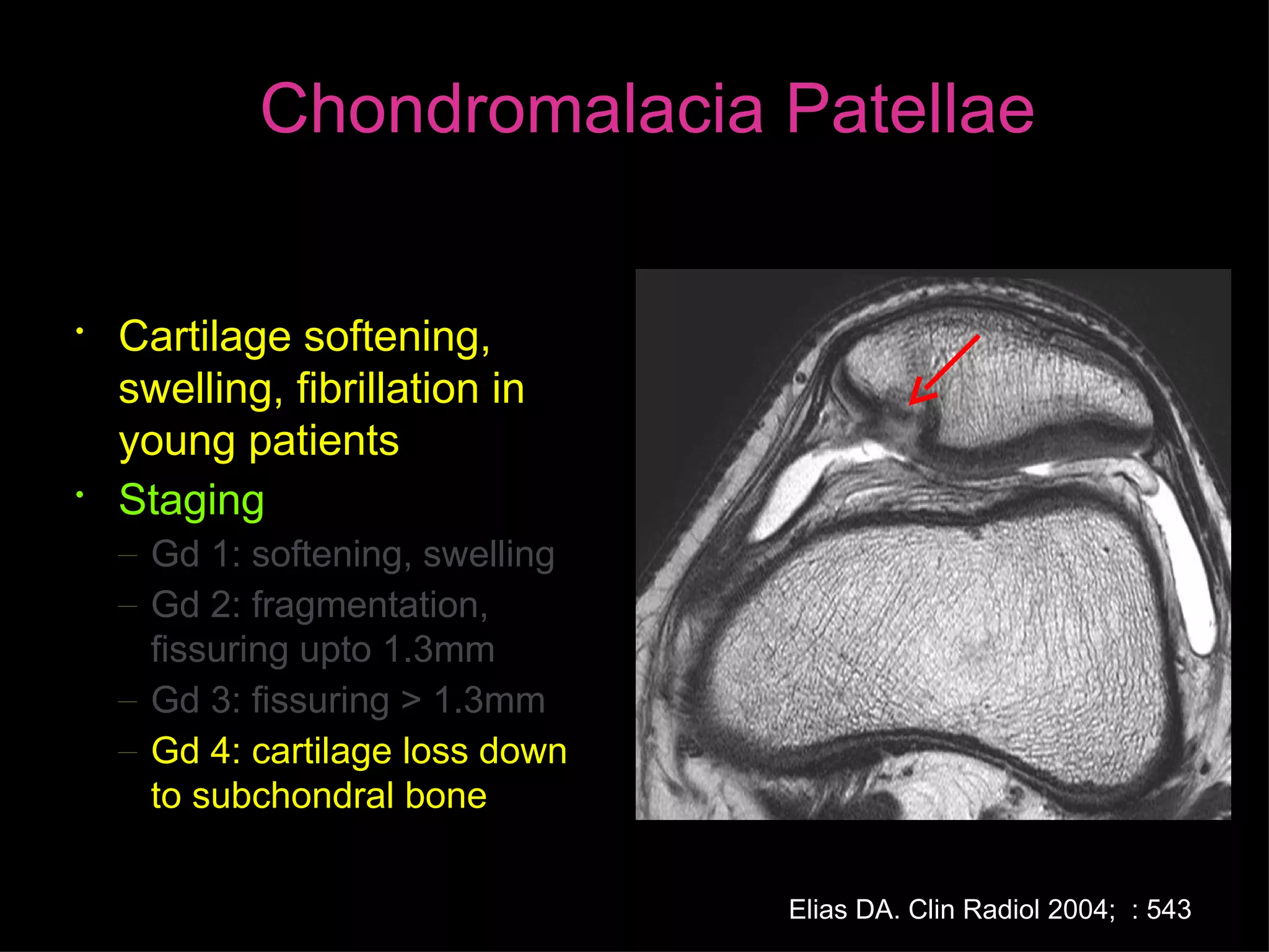 MRI of patellar disorders | PPT