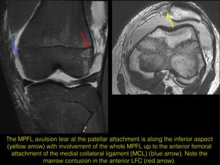 MRI of patellar disorders | PPT
