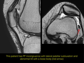 MRI of patellar disorders | PPT