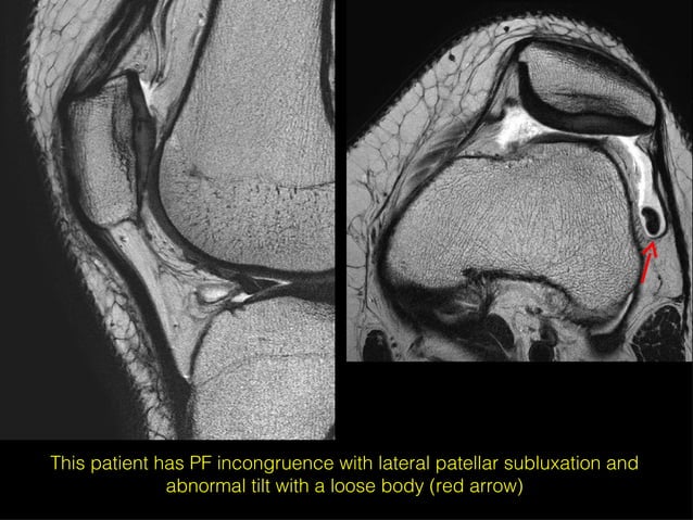 MRI of patellar disorders | PPT | Death, Injury, or Military Conflict ...