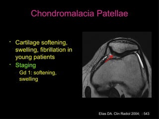 MRI of patellar disorders | PPT