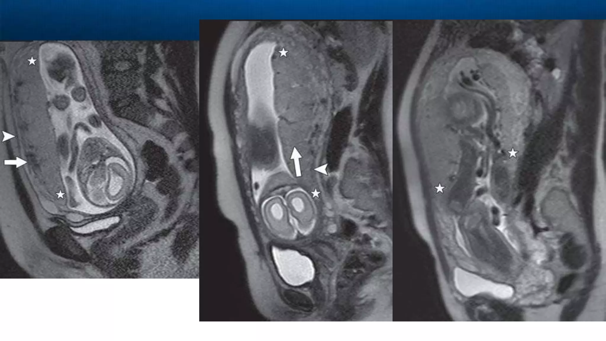 Mri of placenta accreta spectrum | PPTX