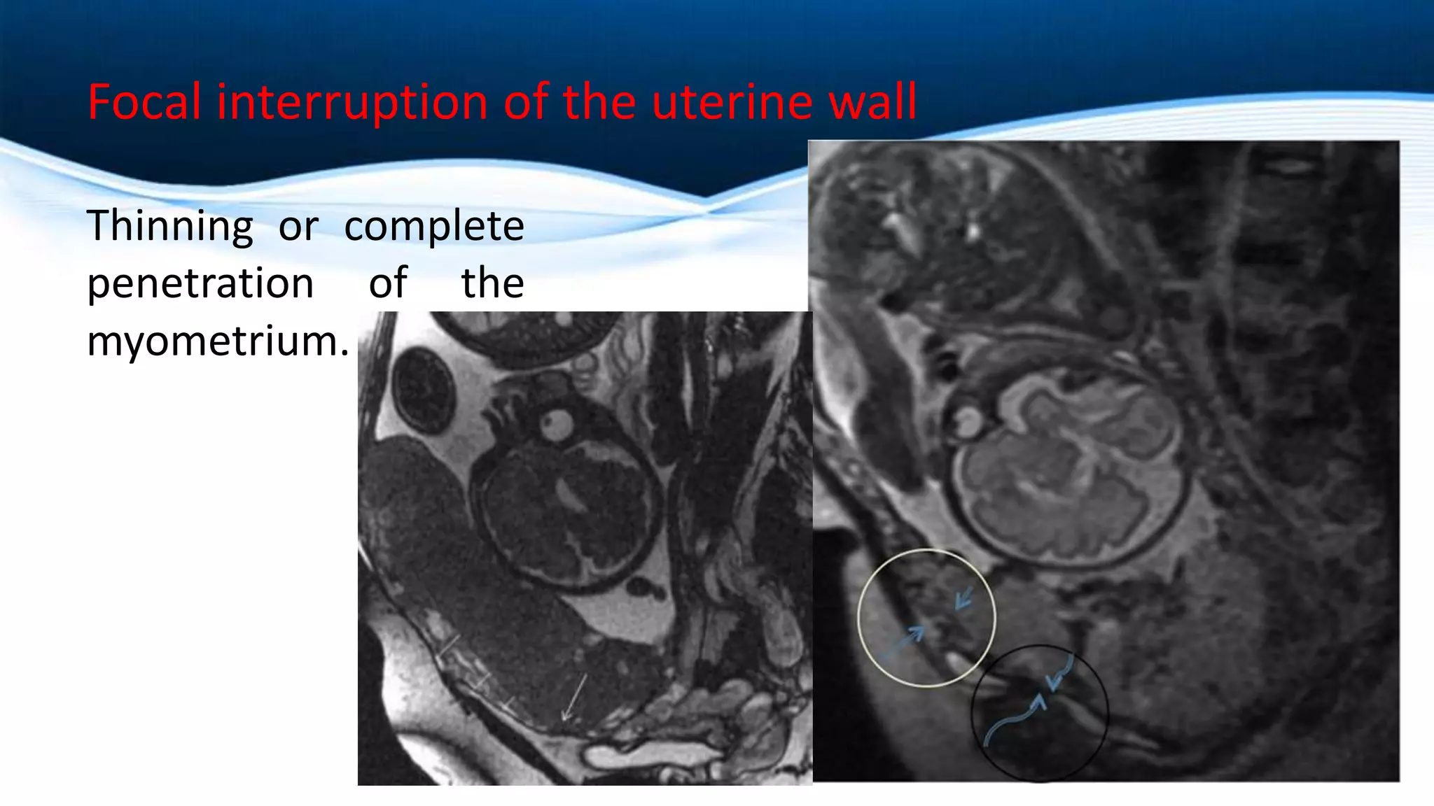 Mri of placenta accreta spectrum | PPTX