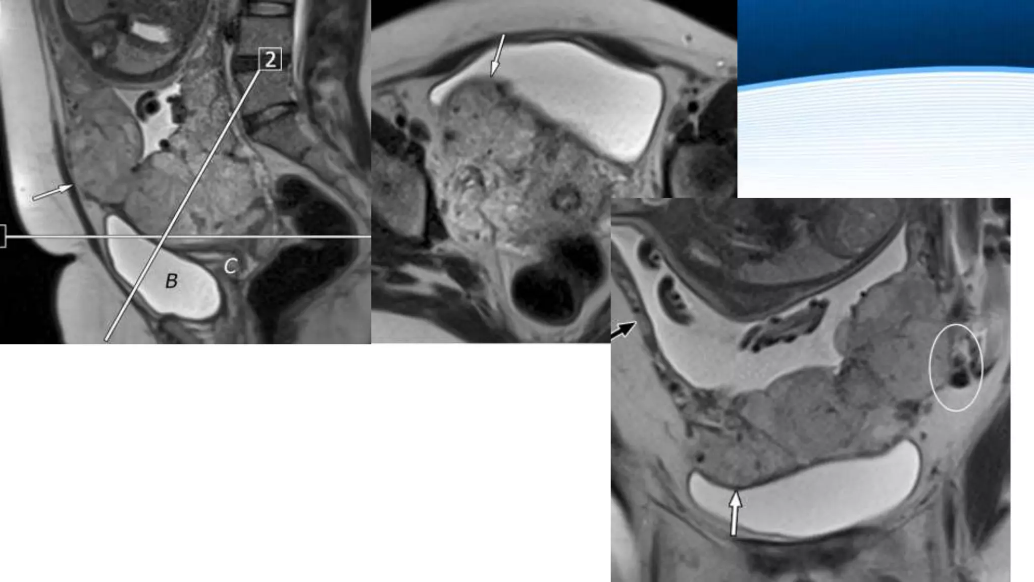Mri of placenta accreta spectrum | PPTX