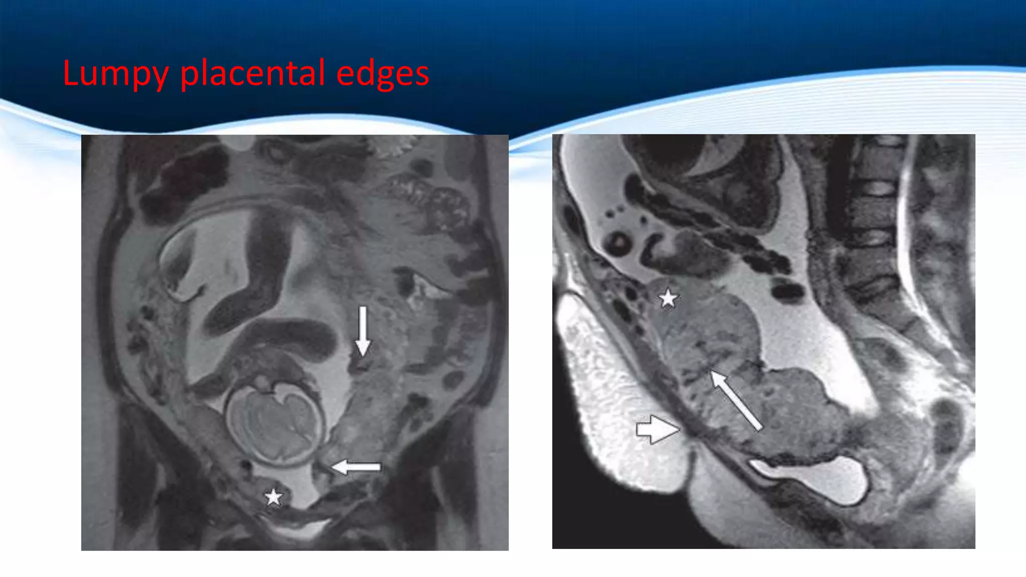 Mri of placenta accreta spectrum | PPTX