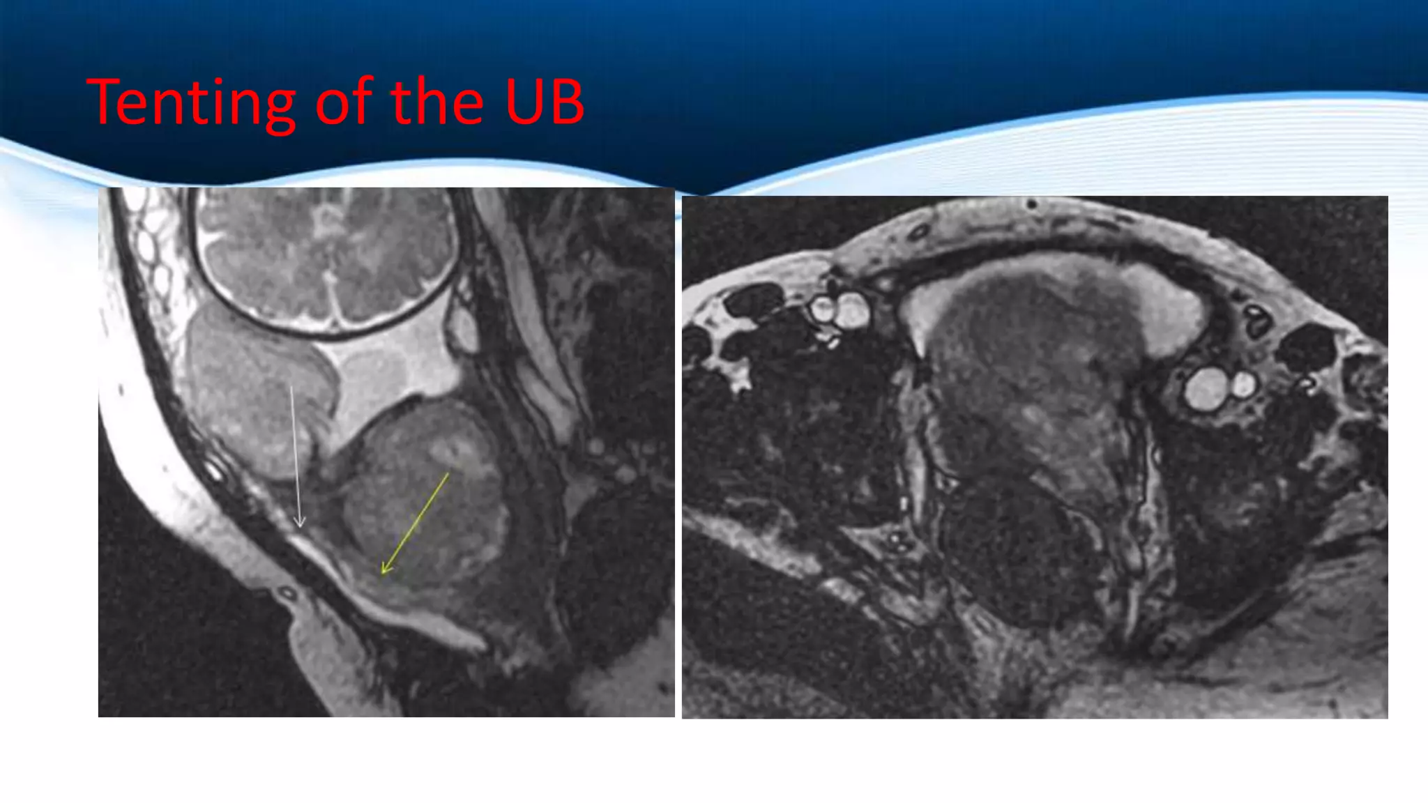 Mri of placenta accreta spectrum | PPTX