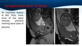 Mri of placenta accreta spectrum | PPTX
