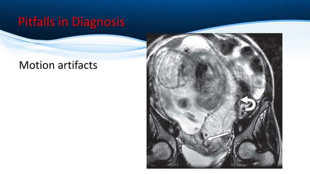 Mri of placenta accreta spectrum | PPTX