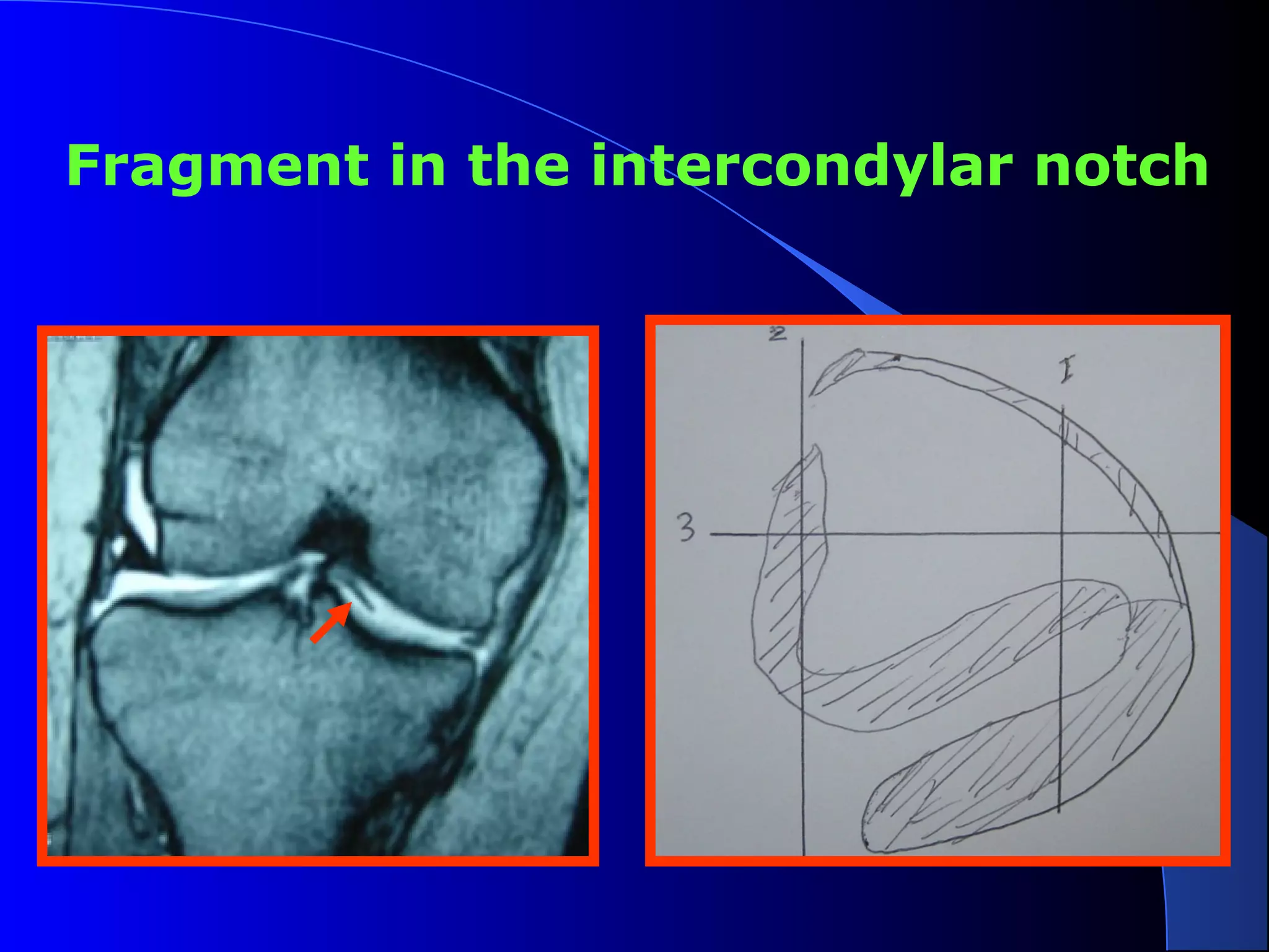MRI of the knee.ppt