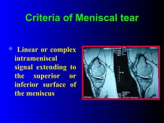MRI of the knee.ppt
