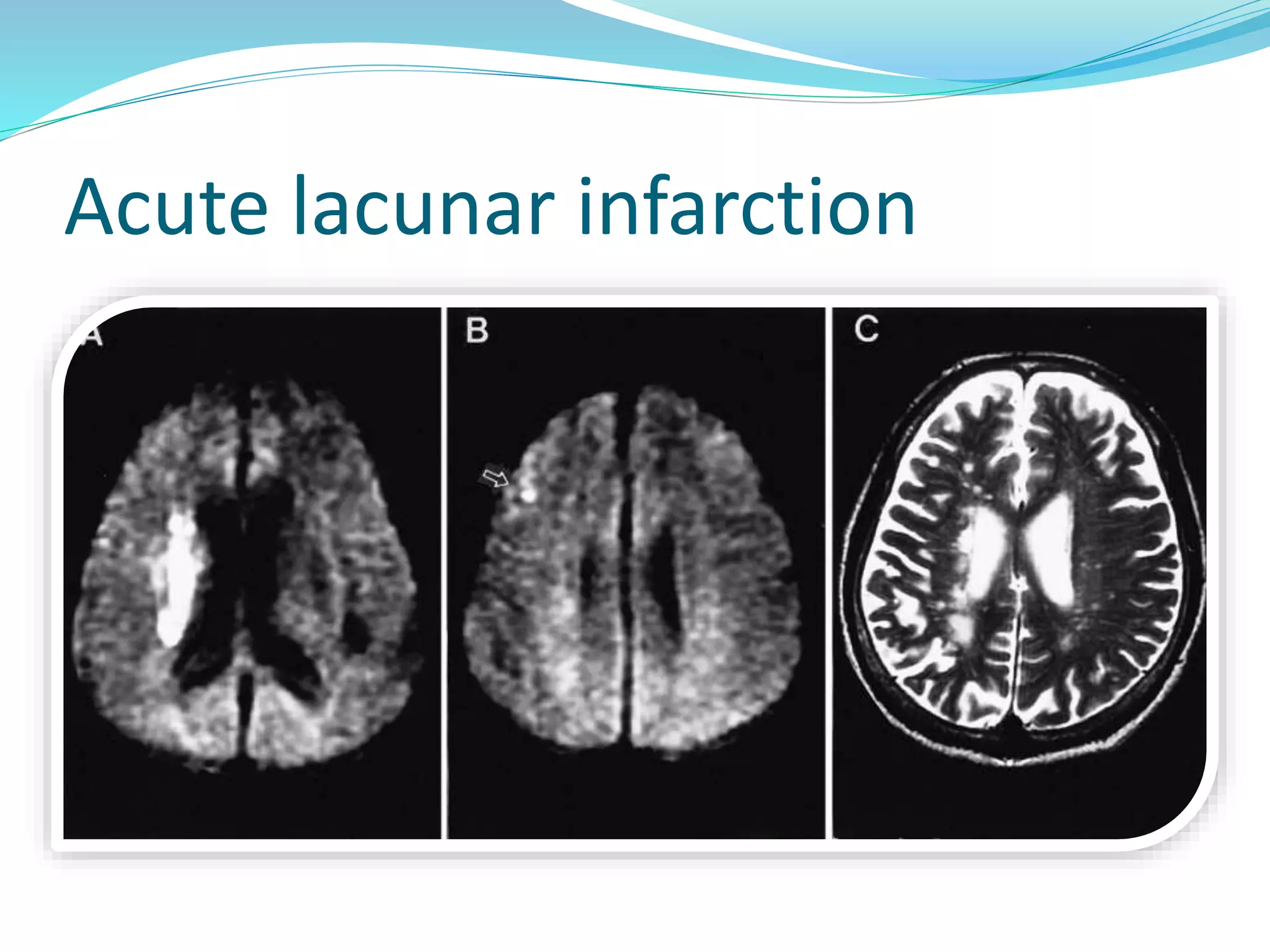 MRI Of White matter.ppt