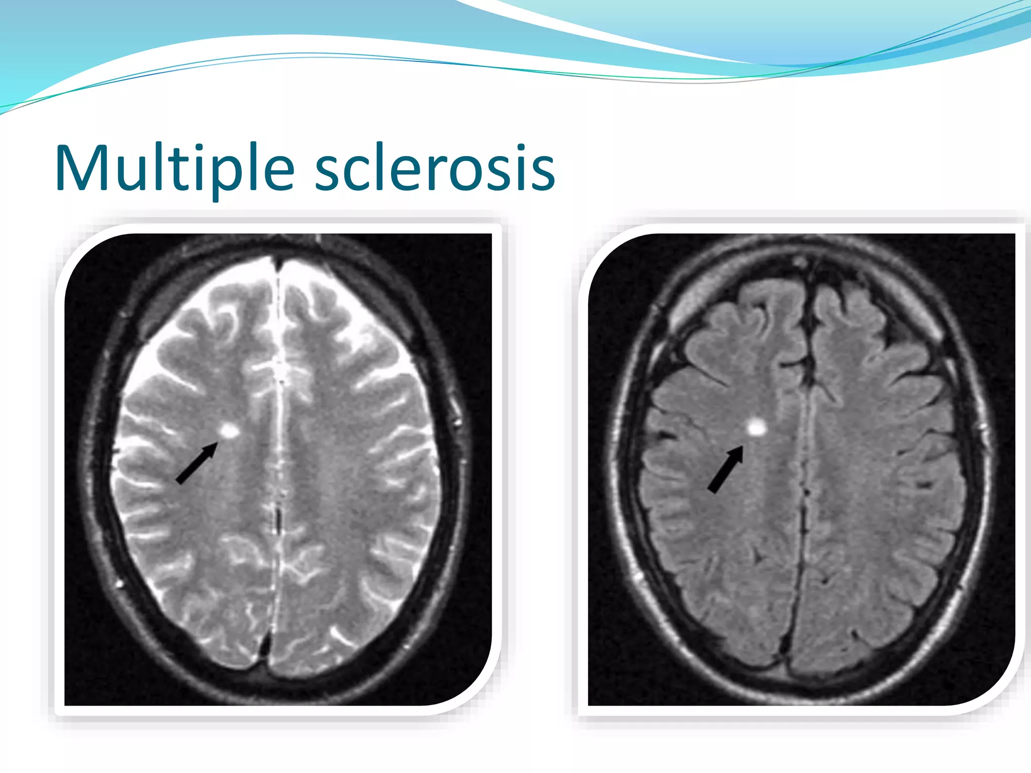 MRI Of White matter.ppt