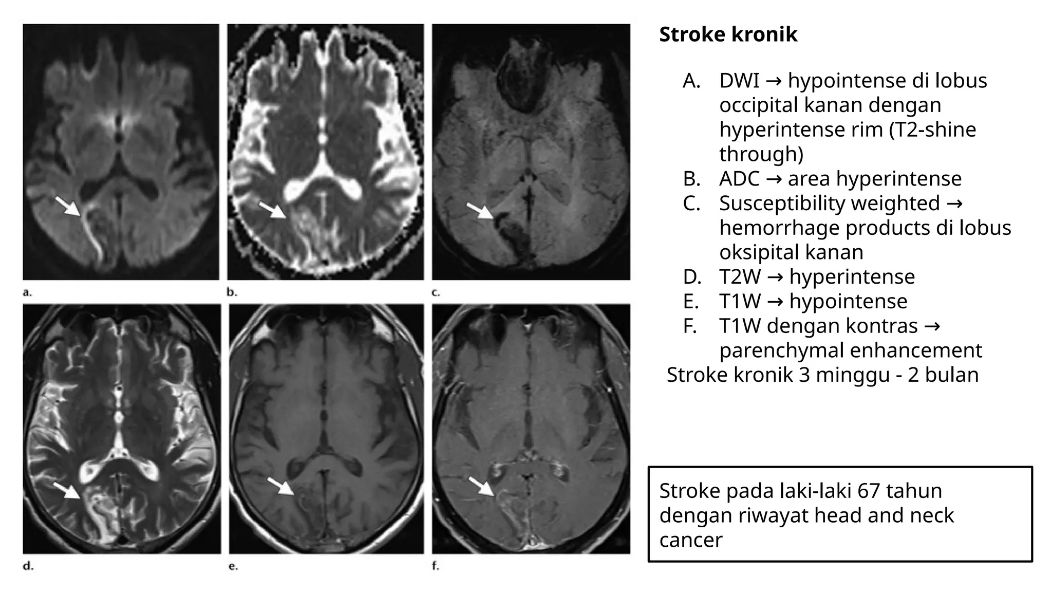 MRI pada Stroke MRI pada Stroke MRI pada Stroke | PPT