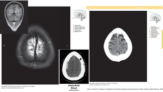 MRI pada Stroke MRI pada Stroke MRI pada Stroke | PPTX