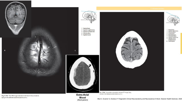 MRI pada Stroke MRI pada Stroke MRI pada Stroke | PPT