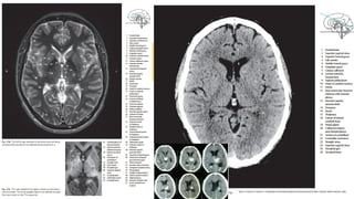MRI pada Stroke MRI pada Stroke MRI pada Stroke | PPTX