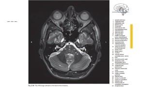 MRI pada Stroke MRI pada Stroke MRI pada Stroke | PPTX