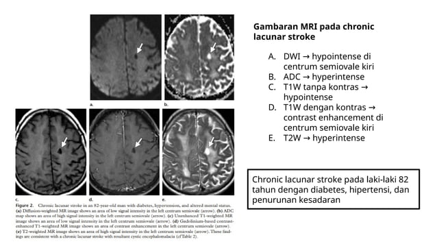 MRI pada Stroke MRI pada Stroke MRI pada Stroke | PPT
