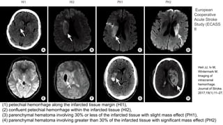 MRI pada Stroke MRI pada Stroke MRI pada Stroke | PPTX