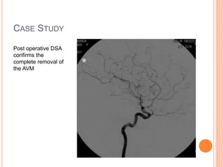 Mri patho avm | PPTX | Brain and Nervous System Disorders | Diseases ...