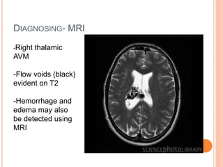 Mri patho avm | PPTX | Brain and Nervous System Disorders | Diseases ...
