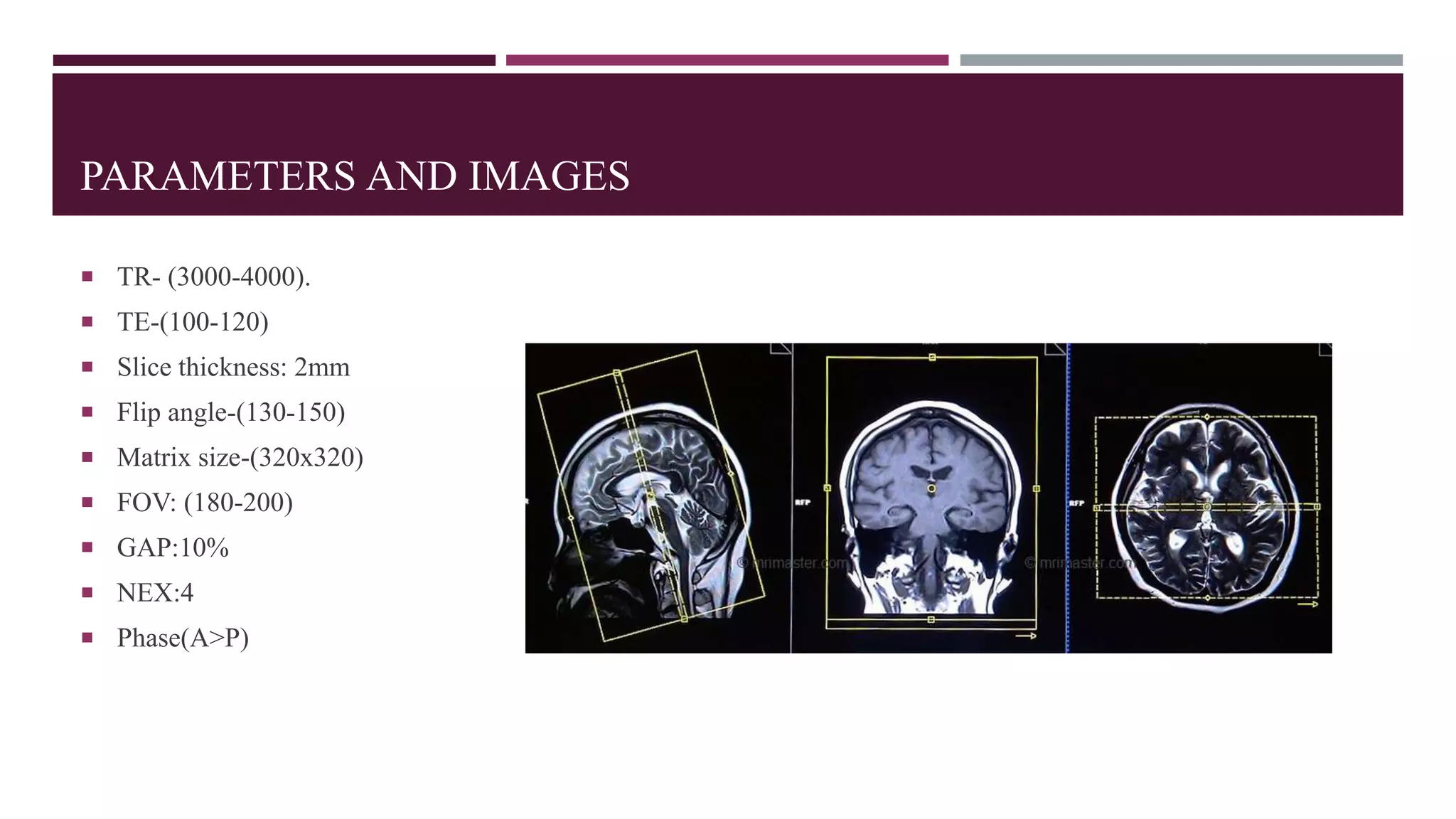 MRI Epilepsy protocol | PPTX