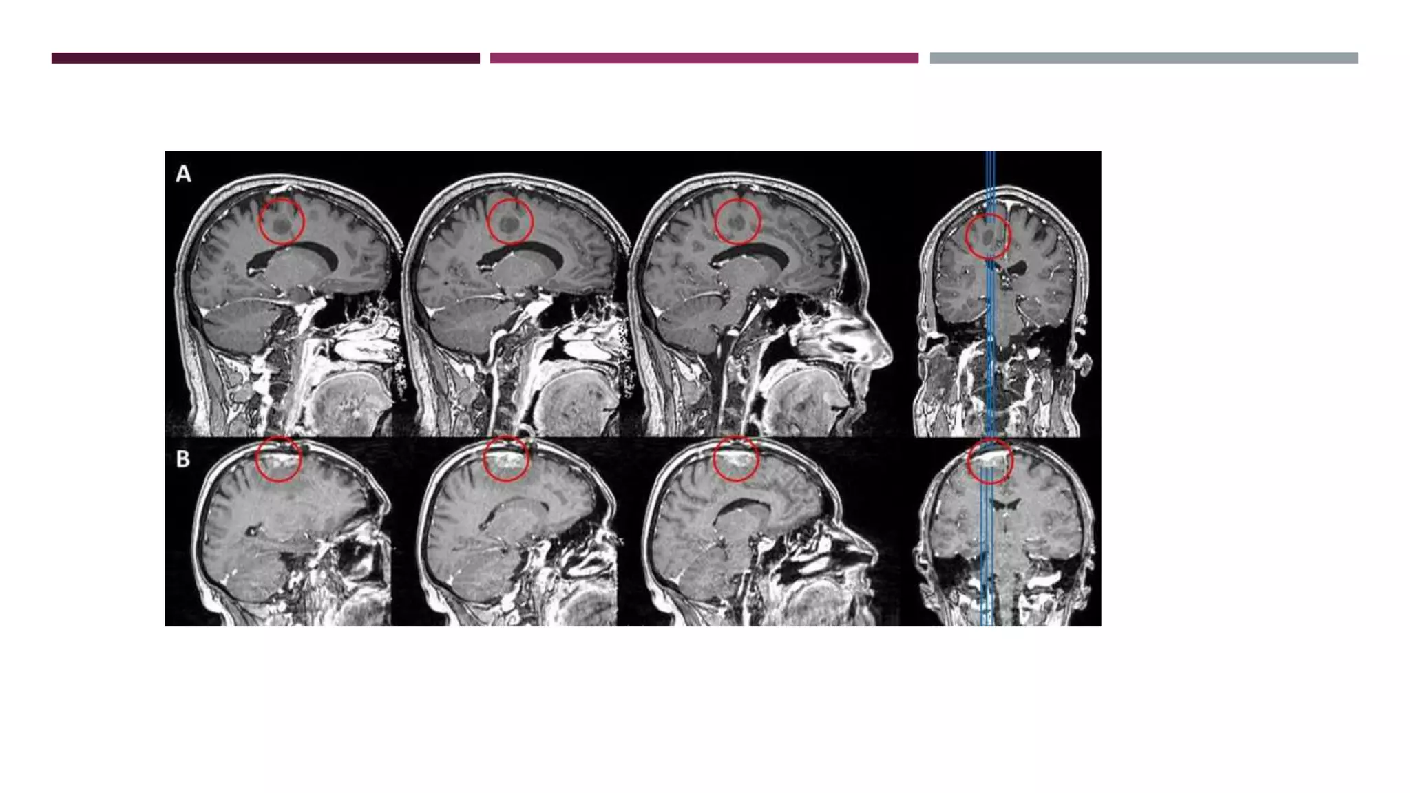 MRI Epilepsy protocol | PPTX