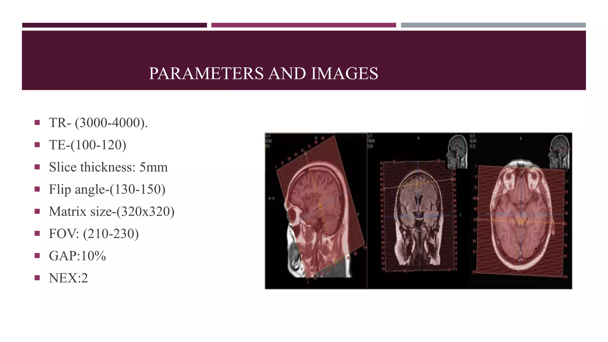 MRI Epilepsy protocol | PPTX