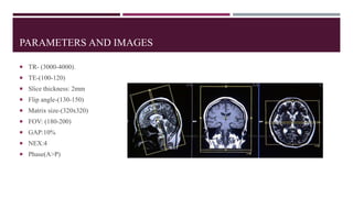 MRI Epilepsy protocol | PPTX