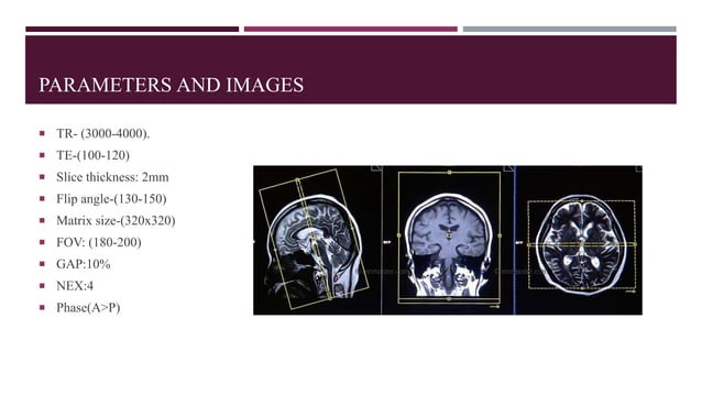 MRI Epilepsy protocol | PPTX | Brain and Nervous System Disorders ...