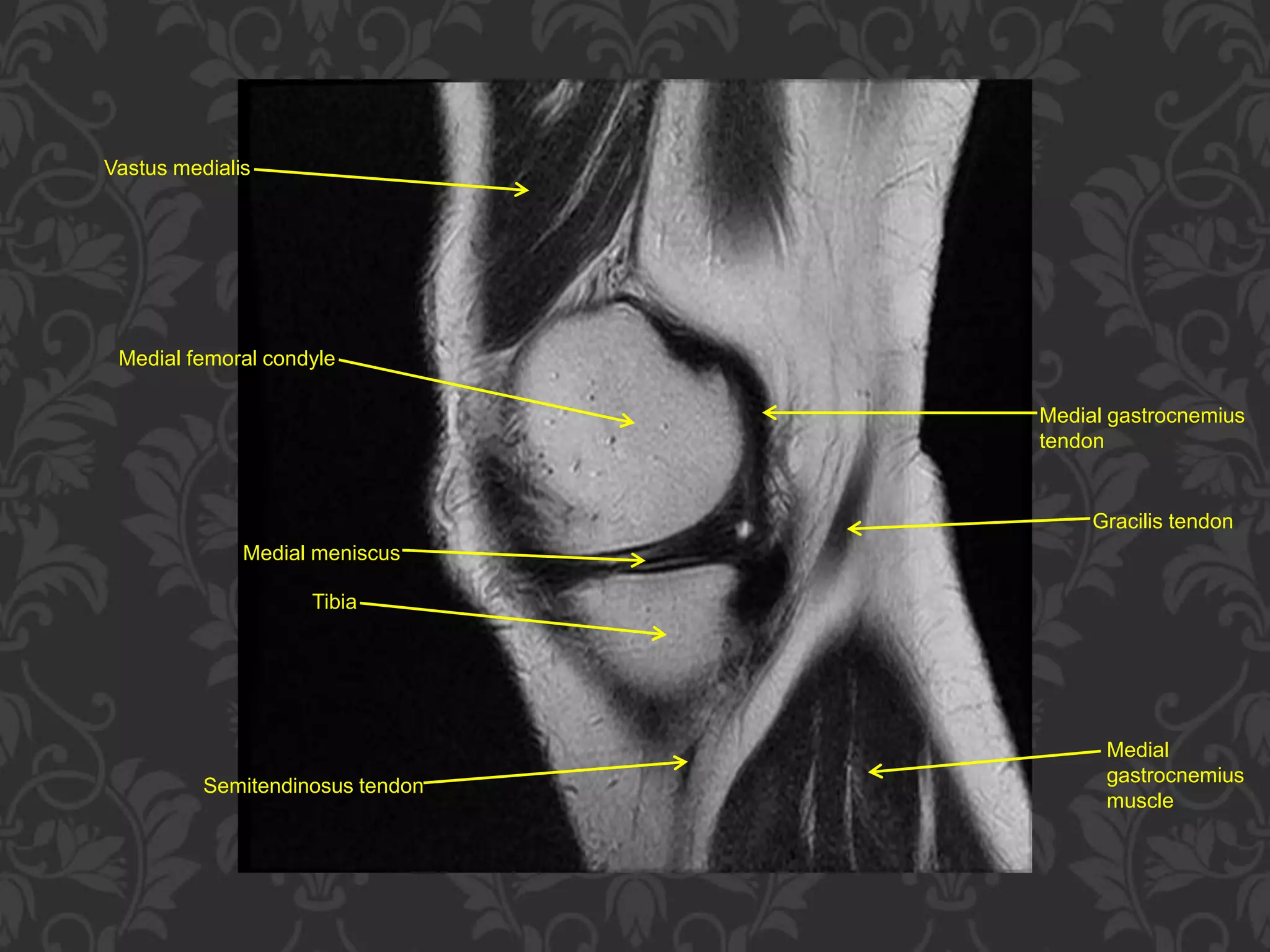 MRI KNEE OF ORTHOPEDIC IMPORTANCE | PPTX