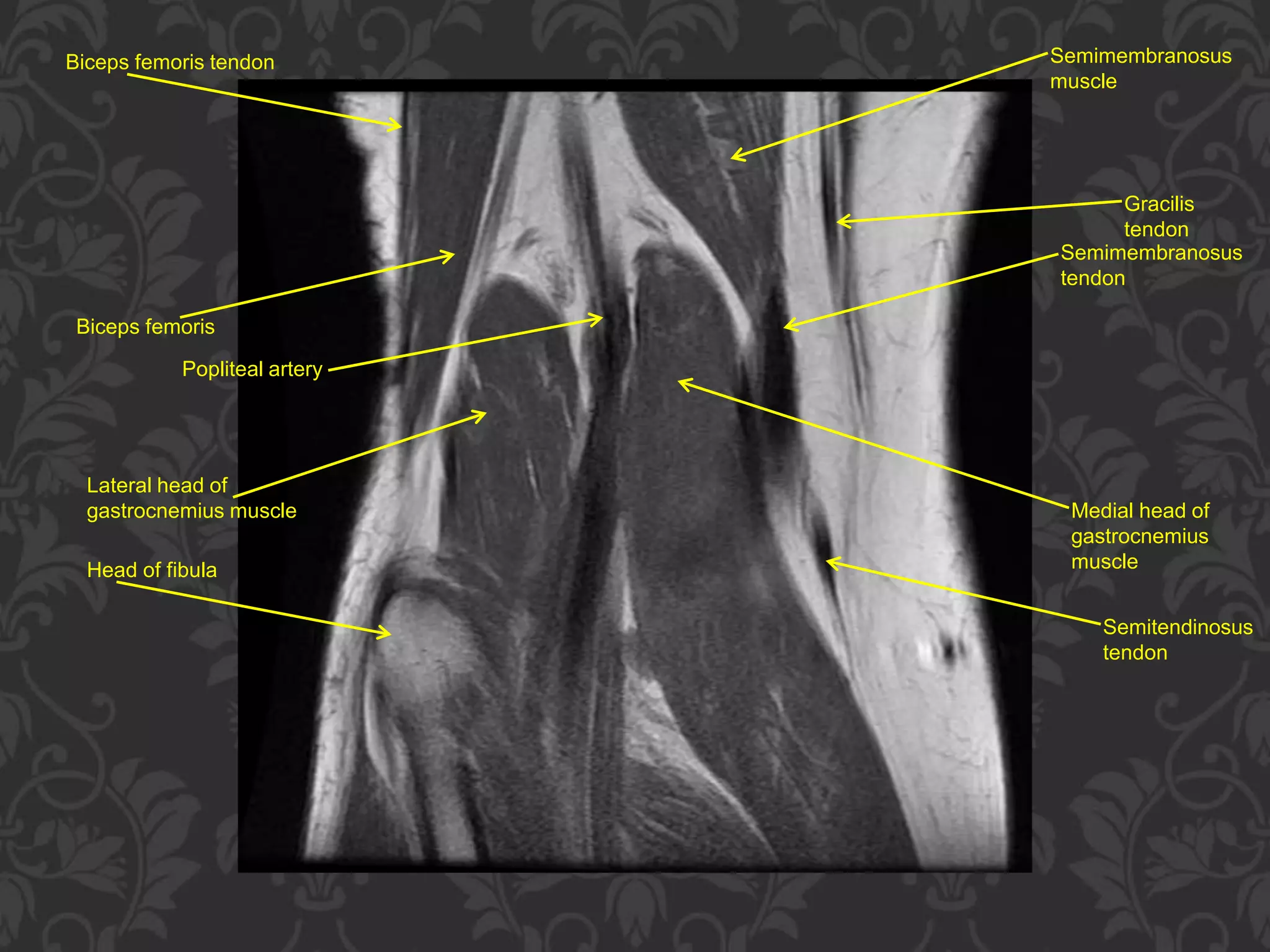 MRI KNEE OF ORTHOPEDIC IMPORTANCE | PPTX