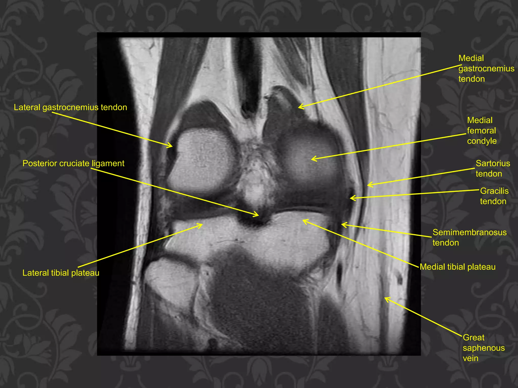 MRI KNEE OF ORTHOPEDIC IMPORTANCE | PPTX