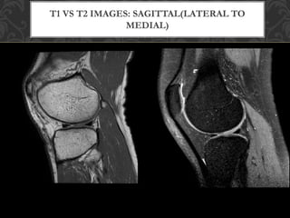 T2 Mri Of The Knee