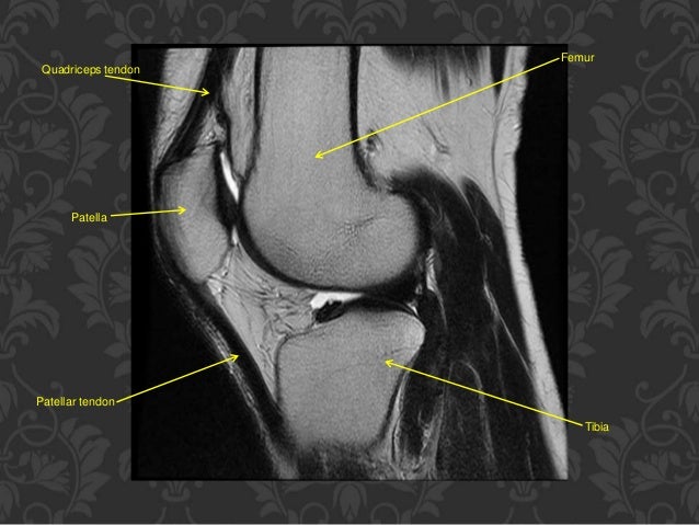 Quadriceps Tendon Mri MRI of Rectus Femoris / Quadriceps Injury - Radsource