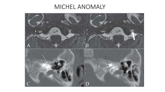 Mri procedure of INTERNAL ACOSTIC MEATUS | PPTX | Ear, Nose and Throat ...