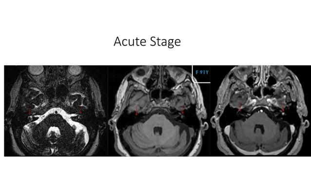 Mri procedure of INTERNAL ACOSTIC MEATUS | PPTX | Ear, Nose and Throat ...
