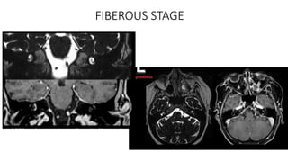 Mri procedure of INTERNAL ACOSTIC MEATUS | PPTX