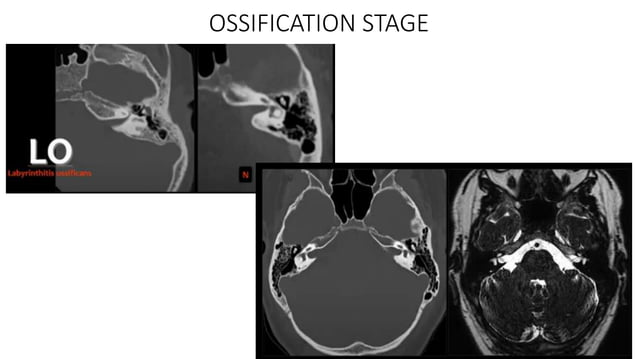Mri procedure of INTERNAL ACOSTIC MEATUS | PPTX | Ear, Nose and Throat ...