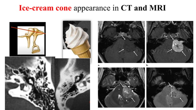 Mri procedure of INTERNAL ACOSTIC MEATUS | PPTX | Ear, Nose and Throat ...