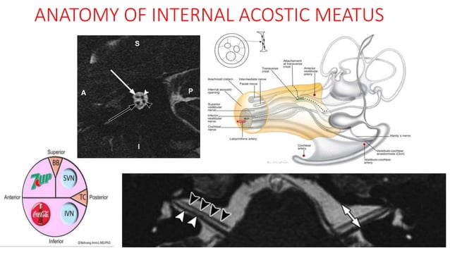 Mri procedure of INTERNAL ACOSTIC MEATUS | PPTX | Ear, Nose and Throat ...